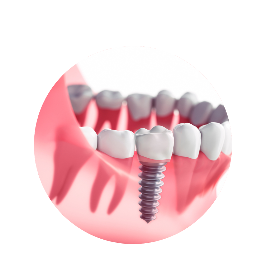 How All-on-4/6 Implants Can Change Your Life: A Life-Changing Solution at Dental Perfection ...